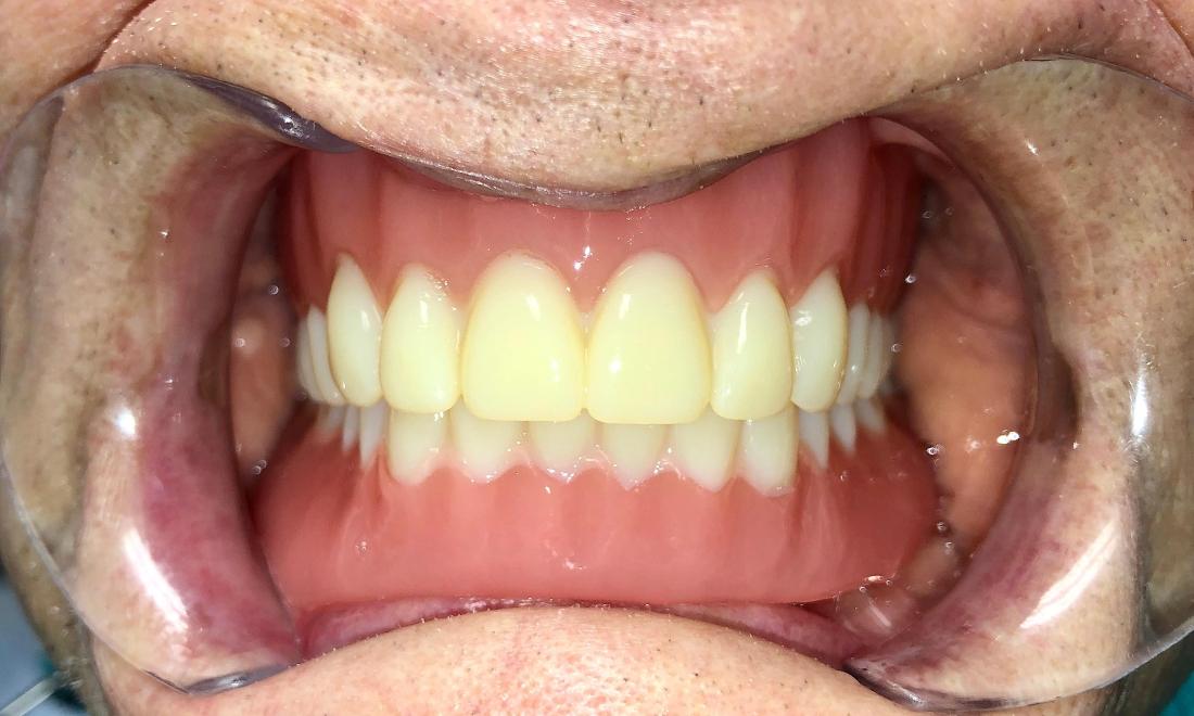 Spare and Copy Denture Before & After Photos | Fort Lauderdale FL