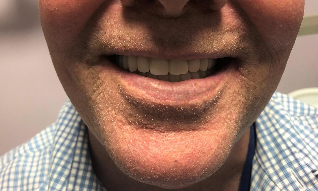 UPPER AND LOWER DIGITAL DENTURES Before & After Photos | Fort Lauderdale FL