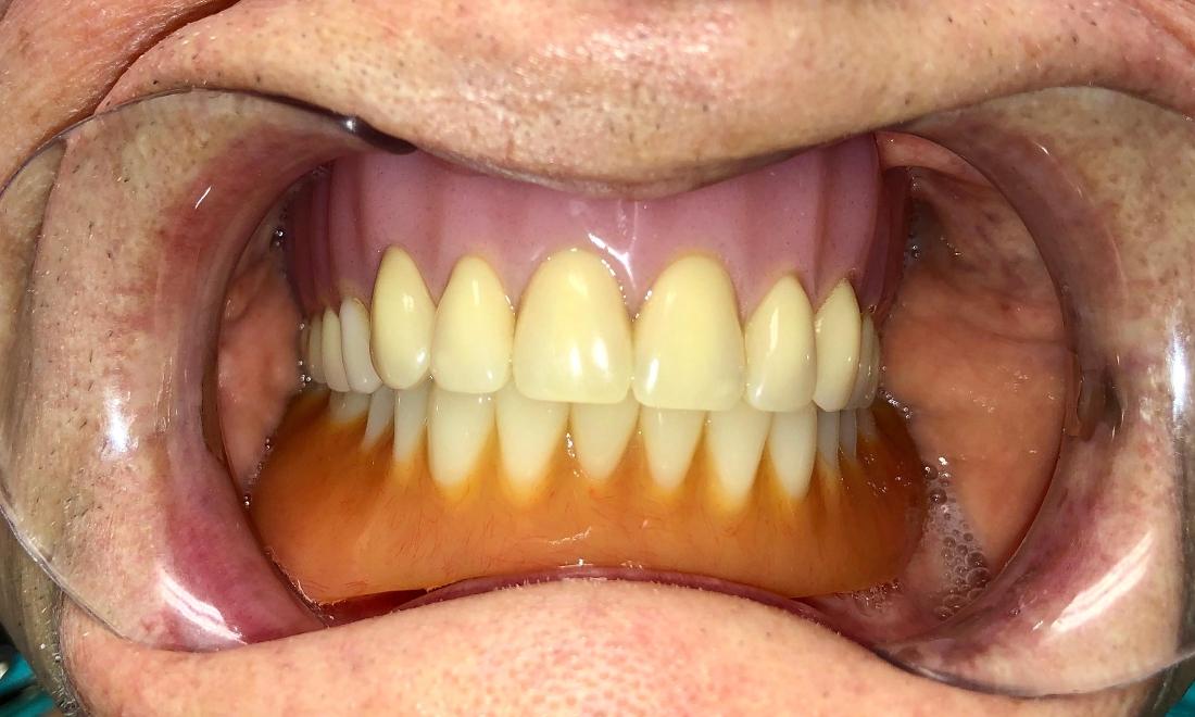 Spare and Copy Denture Before & After Photos | Fort Lauderdale FL
